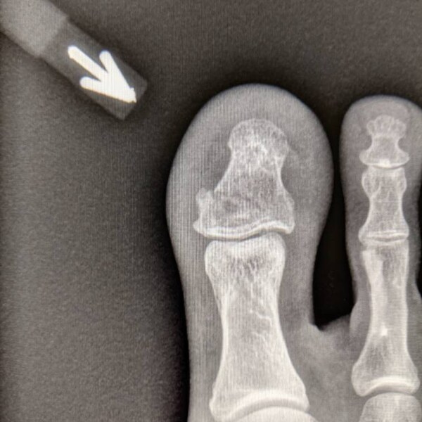 Arrow Xray Marker, Upright, Erect, Long Skinny Rectangle - Etsy