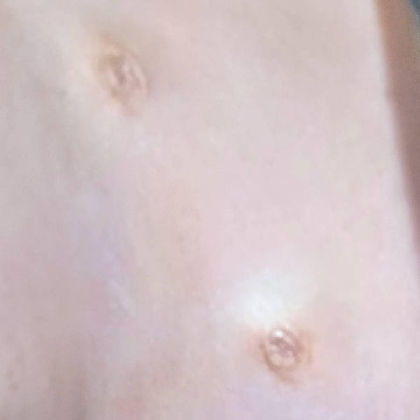 Third-degree Burns / Encapsulated Silicone Prosthetic / SFX MAKEUP ...